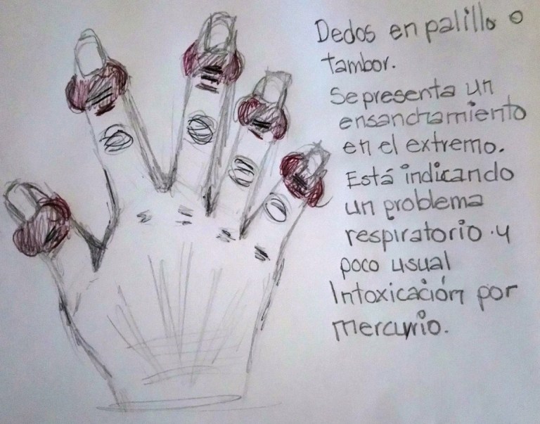 DEFORMACIÓN DE LOS DEDOS. – Belleza Micrón.
